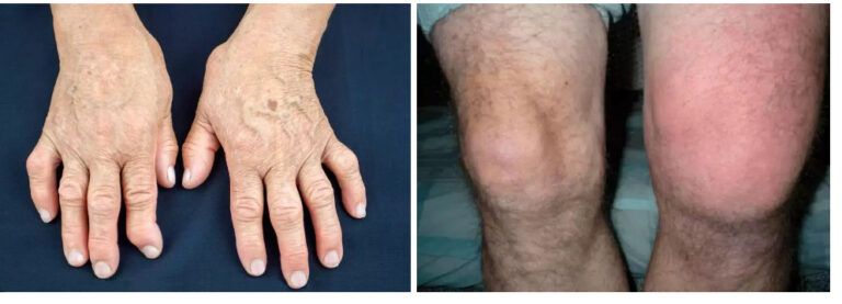 Artropan - krema - cena - iskustva - kako se koristi